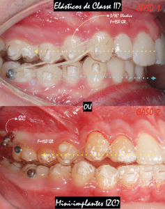 Alinhadores na correção da Classe II: elásticos intermaxilares ou mini ...